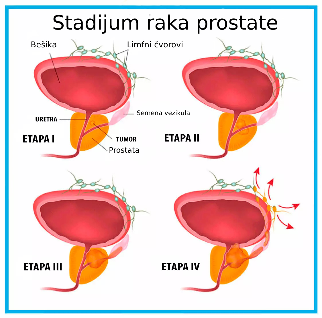 ŠTA NAM APOTEKE PRODAJU ZA LEČENJE PROSTATISA – buditezdravi.net
